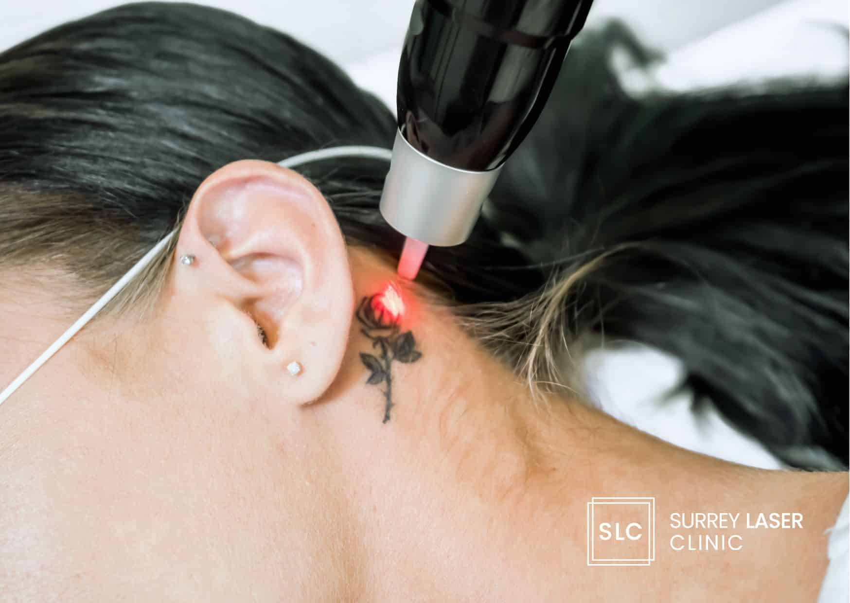 Fresh Starts & Faded Ink: Pico Laser Tattoo Removal at Surrey Laser Clinic